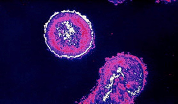 Noul mod prin care barbatii transmit SIDA femeilor