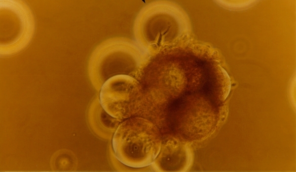 Specialiştii recomandă pastilele de prevenire a cancerului de sân