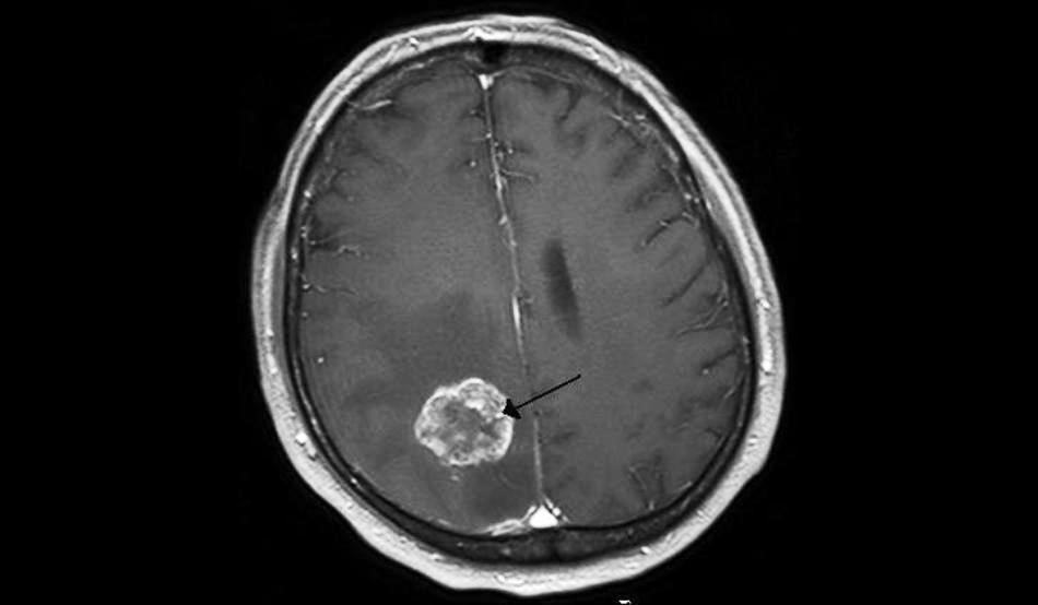 „Doctorii” banale ar putea opri dezvoltarea unor tumori canceroase