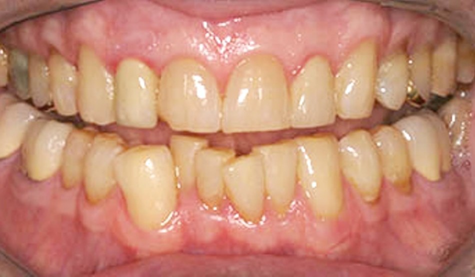 De ce mulţi oameni au dinţii înghesuiţi? Din cauza alimentaţiei ...