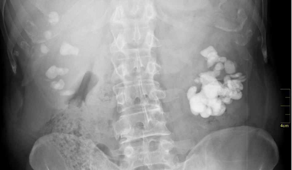 Un aşa-zis „obicei sănătos” dublează riscul apariţiei pietrelor la rinichi