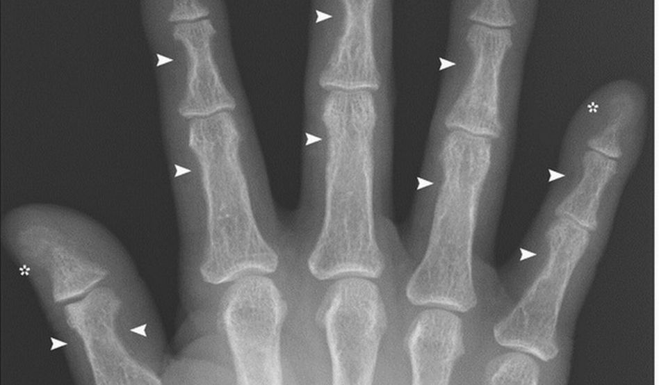Medicii nu mai văzuseră aşa ceva. Oasele pacientului au fost pur şi ...