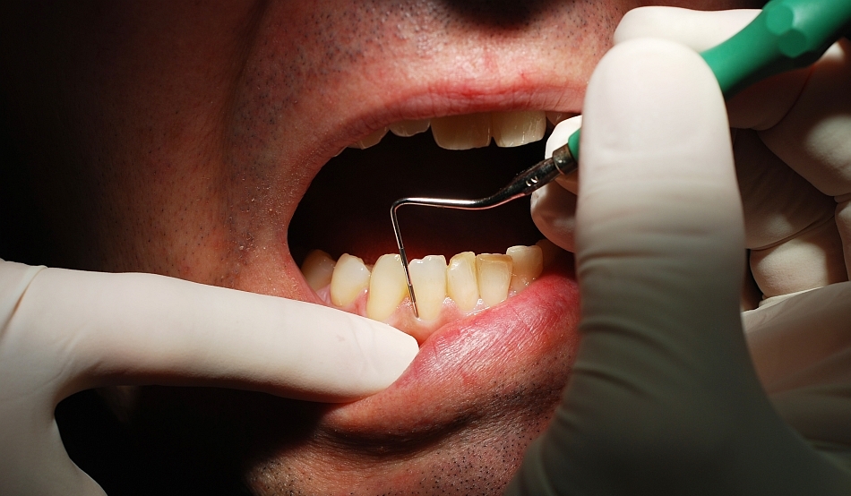 TREBUIE sau NU să ne lipsim de molarii de minte? Cercetătorii din ...