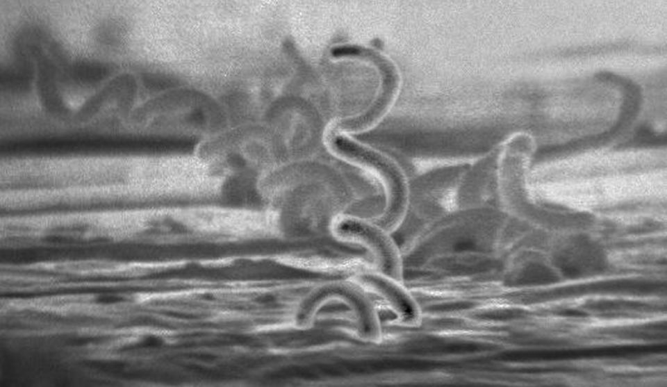 Sifilisul: cauze, simptome şi tratament