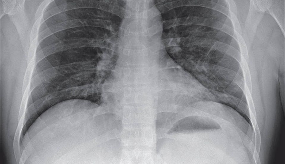 Când apare sindromul ''plămânului alb'', manifestare extrem de gravă a ...