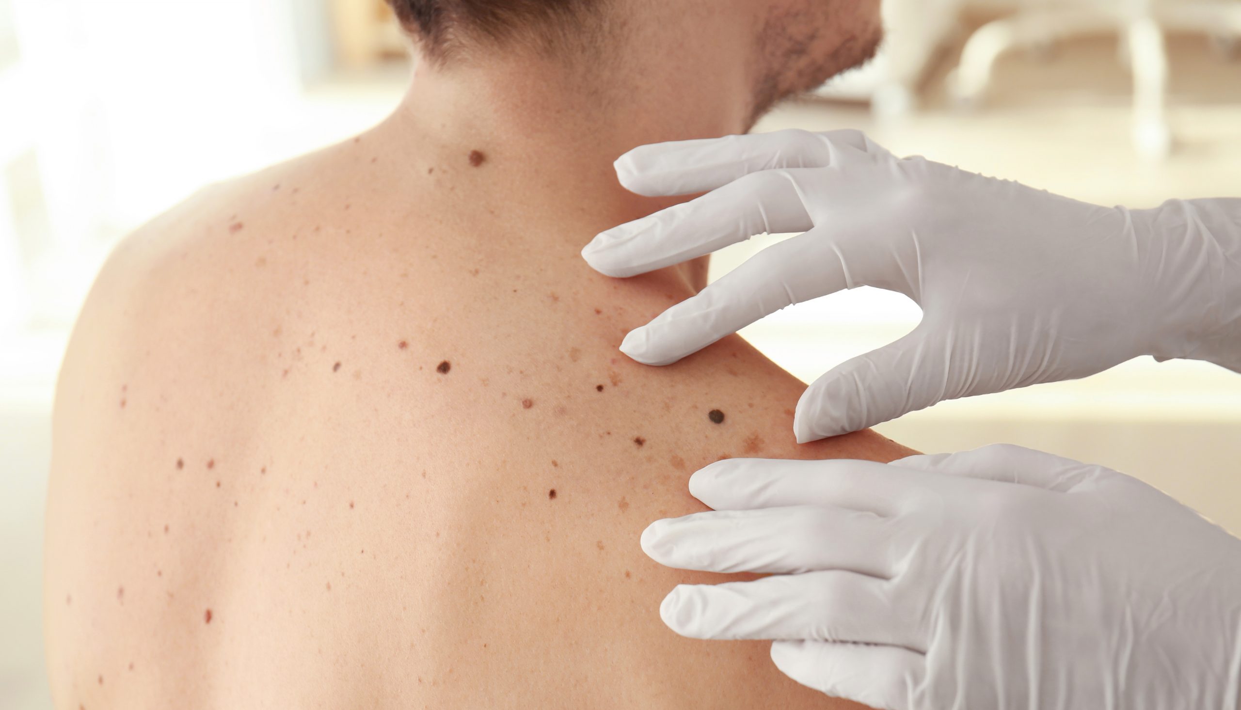 Echipament unic în România. Aparatul care descoperă cancerul de piele