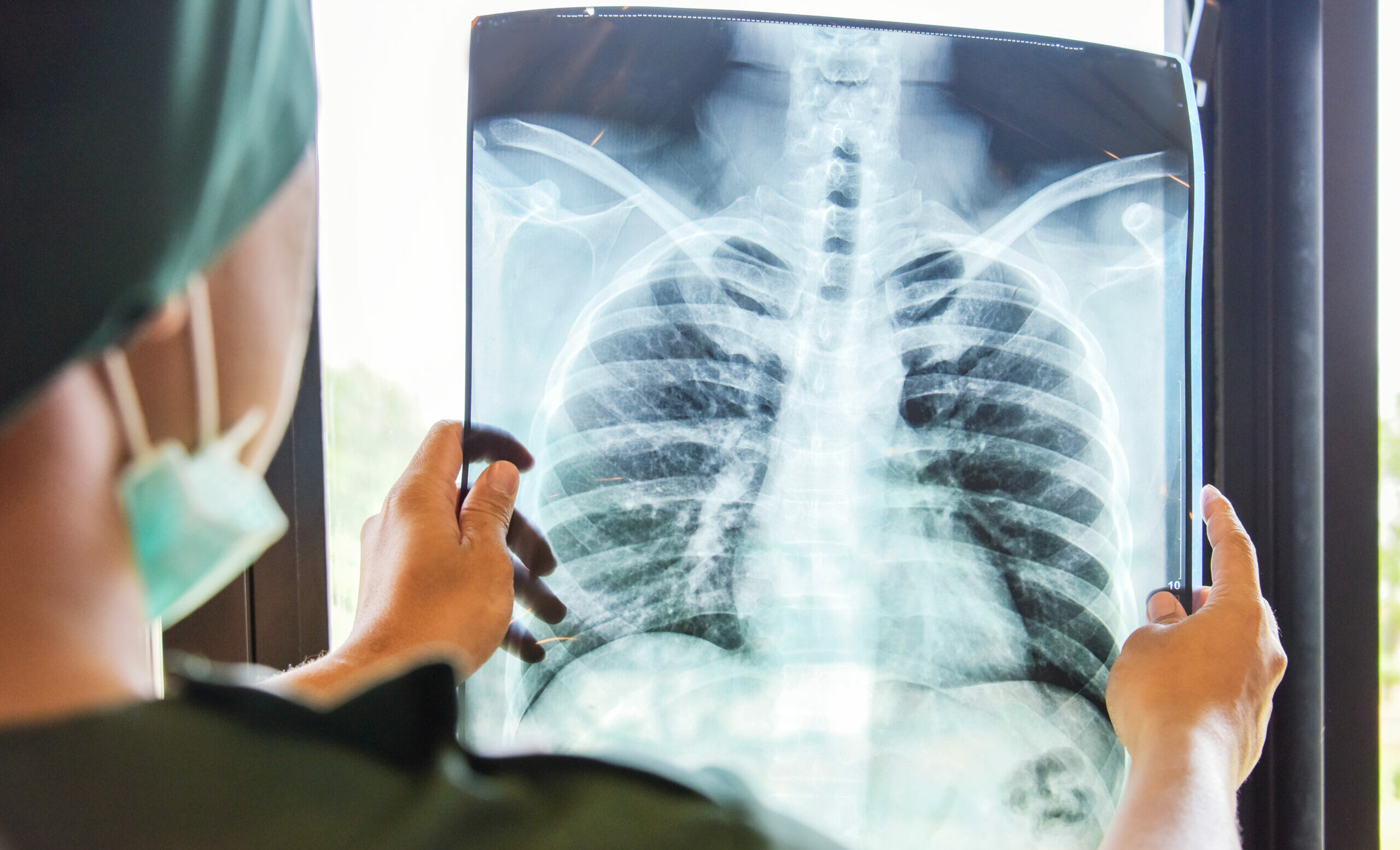 Prea multe cazuri de pneumonie, atrag atenția medicii. Care este cauza?