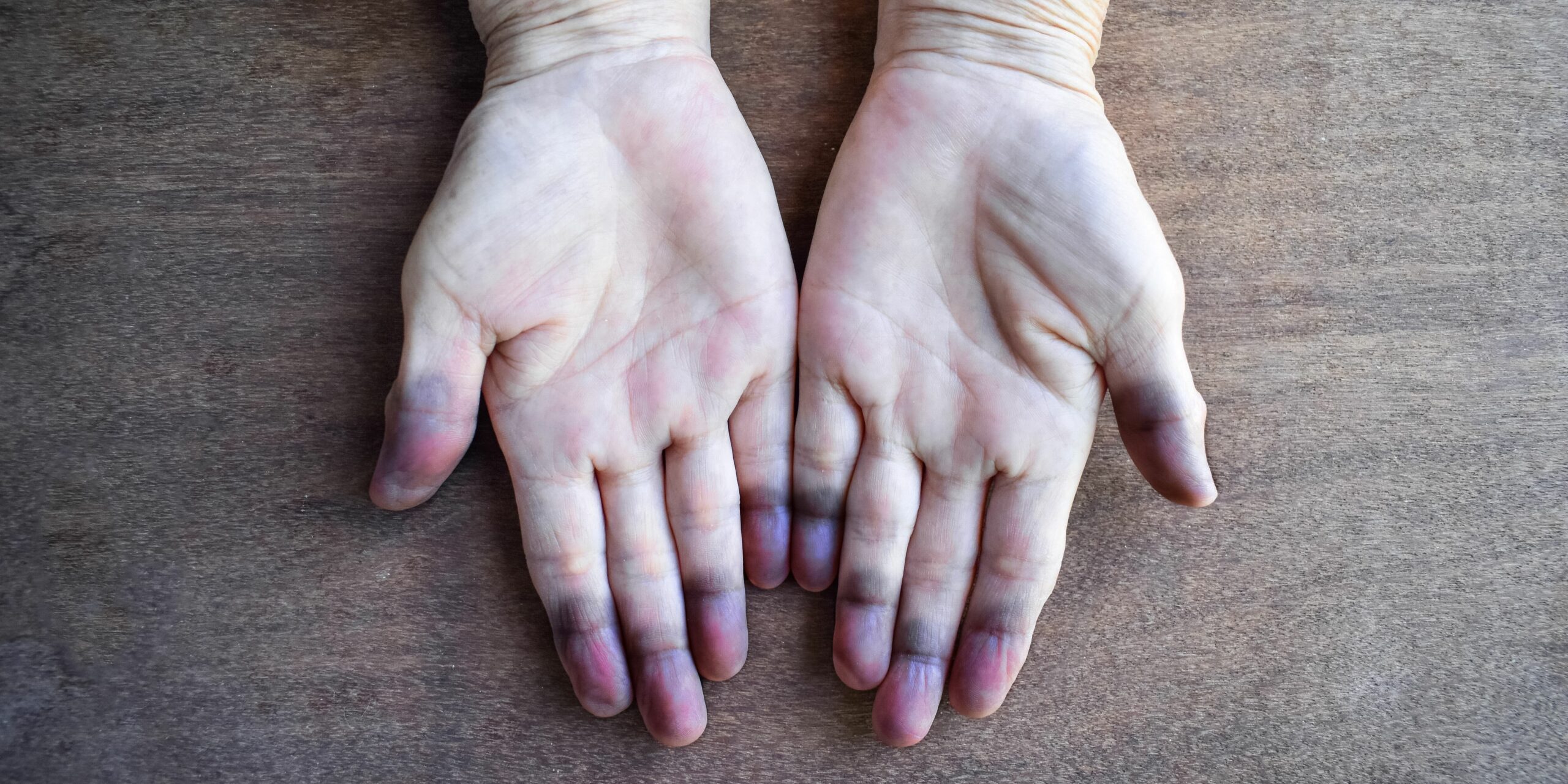 „Degetele albastre” sau ce poți păți dacă fumezi prea multă „iarbă”