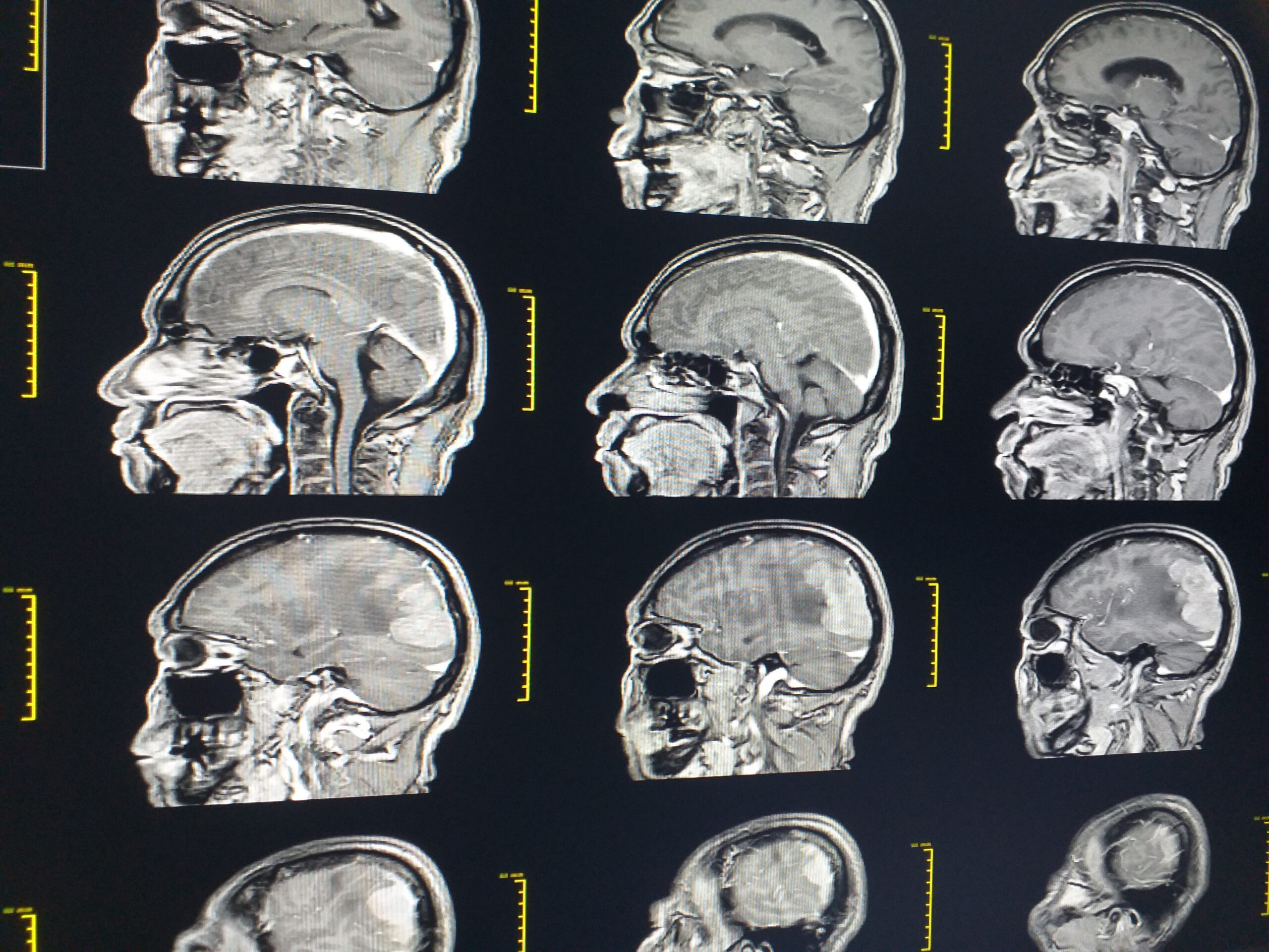 Memoria de scurtă durată poate fi îmbunătățită prin terapia cu laser
