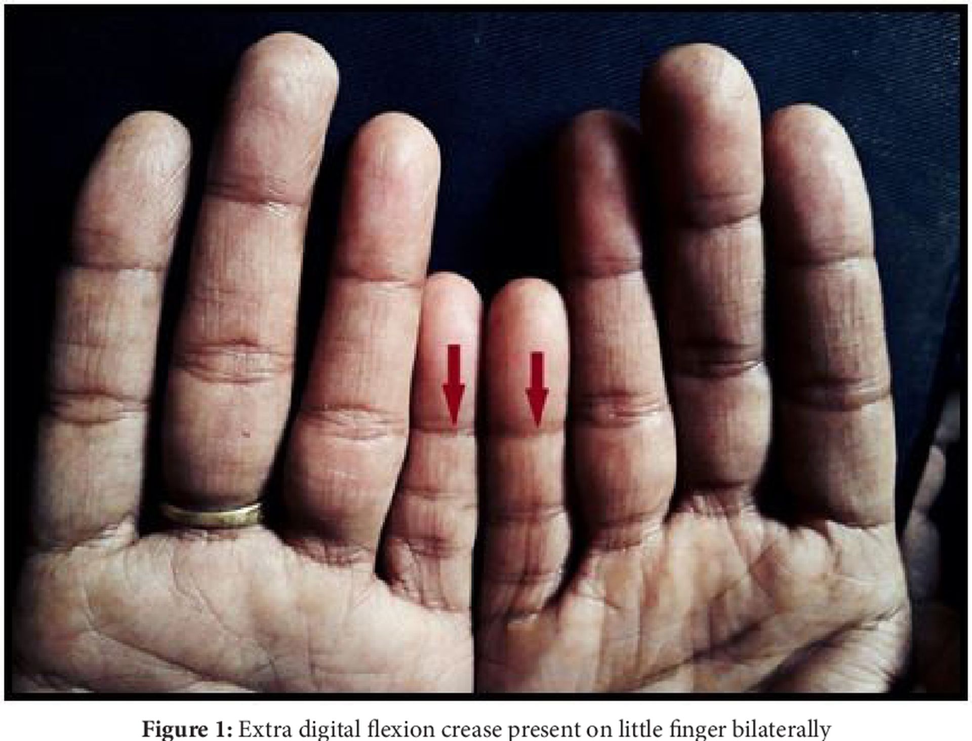 Oamenii care au această încrețitură pe degetul mic sunt o raritate