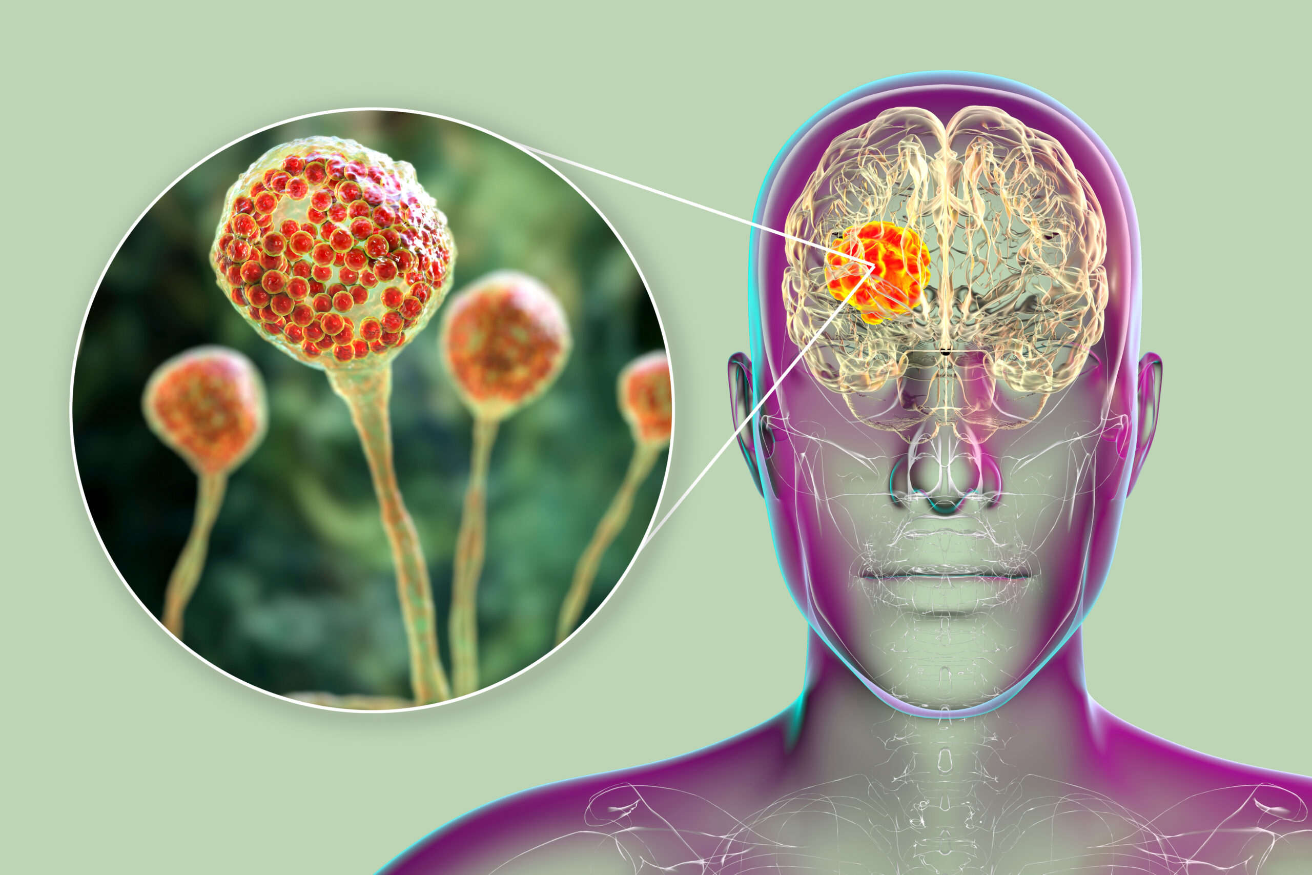 Amiba mâncătoare de creier poate fi cauzată prin spălături nazale