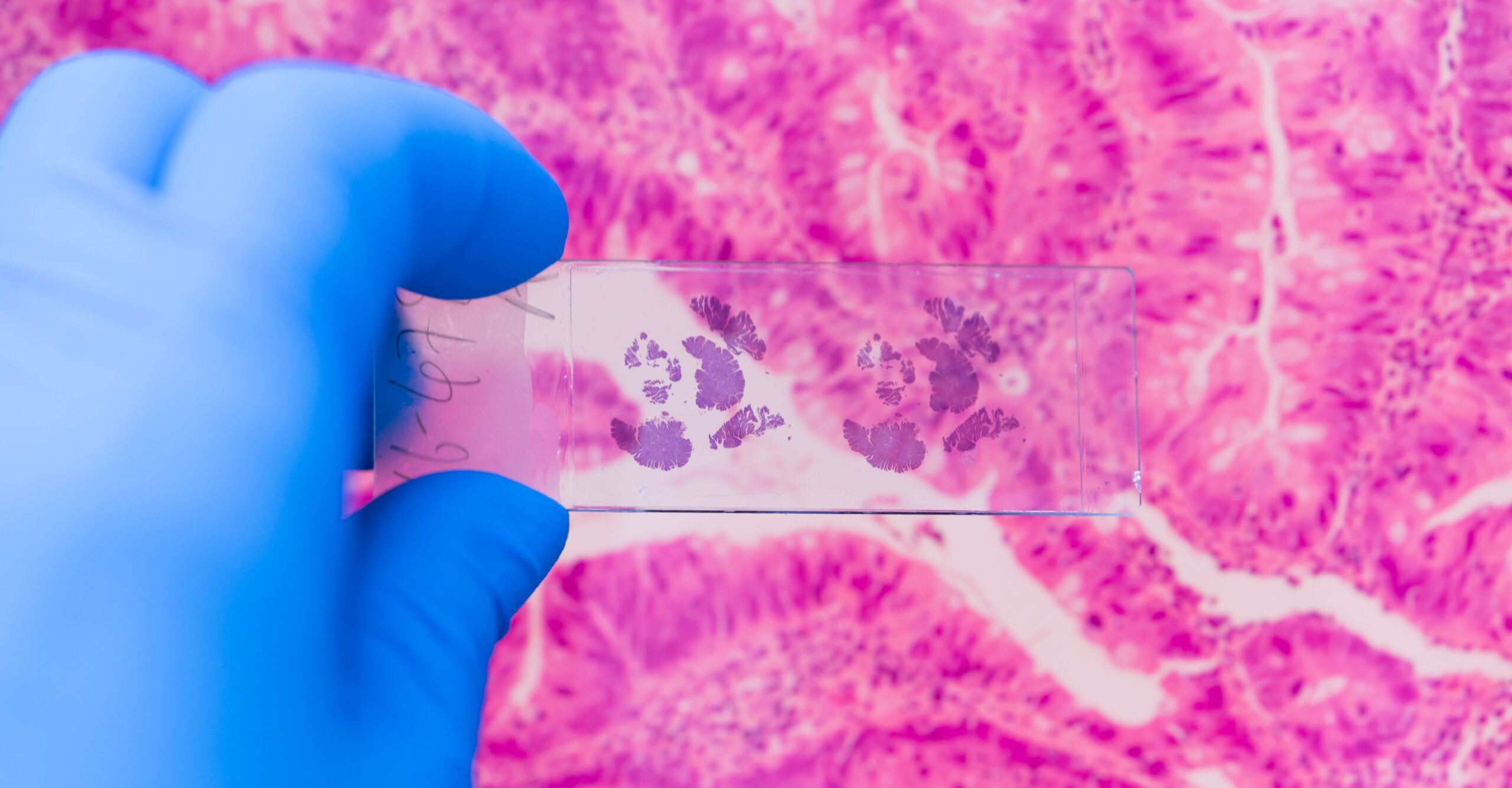 Cercetătorii canadieni anunță o descoperire majoră în lupta împotriva ...